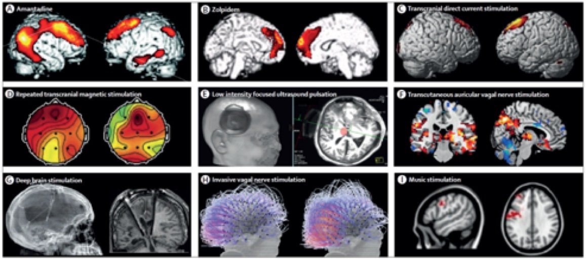 Severe Brain Injury – Coma Science Group