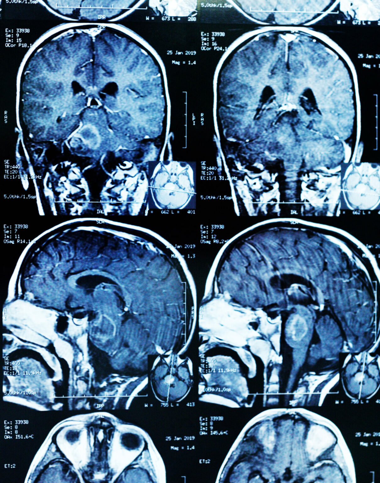 Severe Brain Injury – Coma Science Group